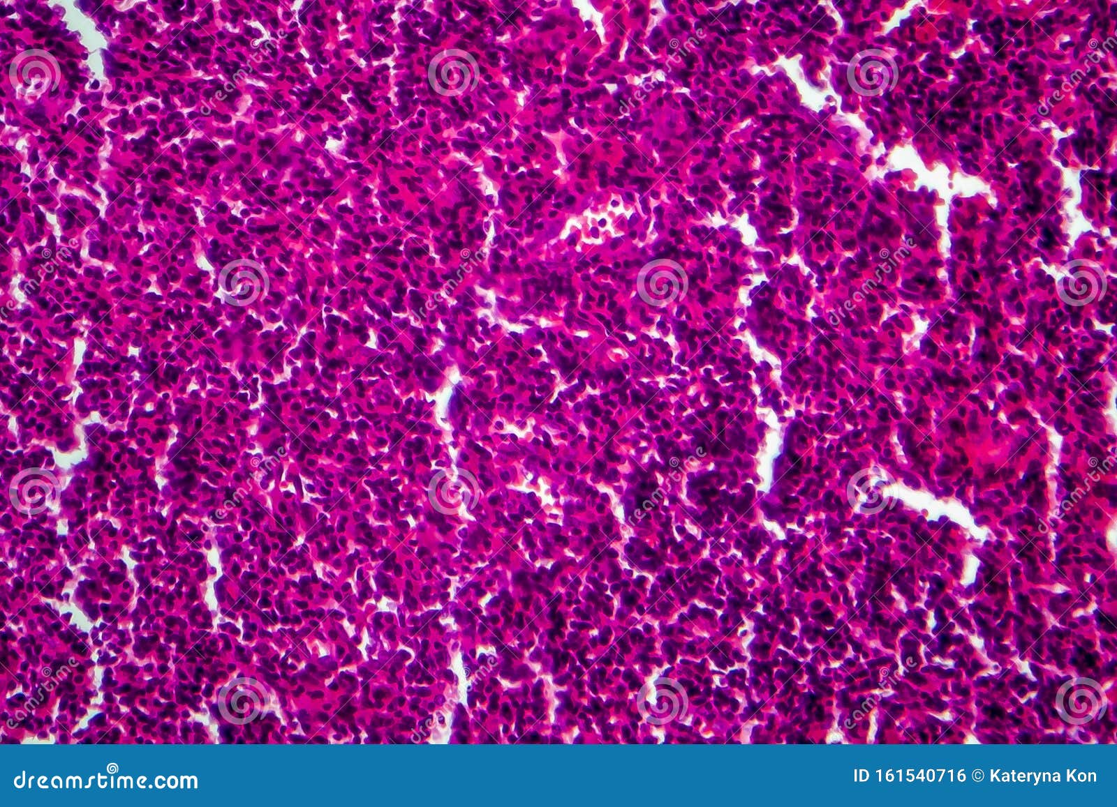 Non-Hodgkin`s Lymphoma, Light Micrograph Stock Photo - Image of white ...
