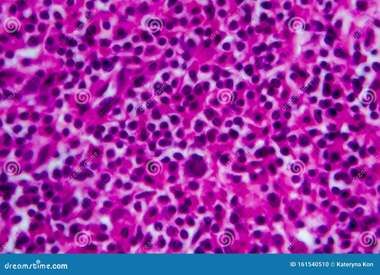 Non-Hodgkin`s Lymphoma, Light Micrograph Stock Photo - Image of micro ...