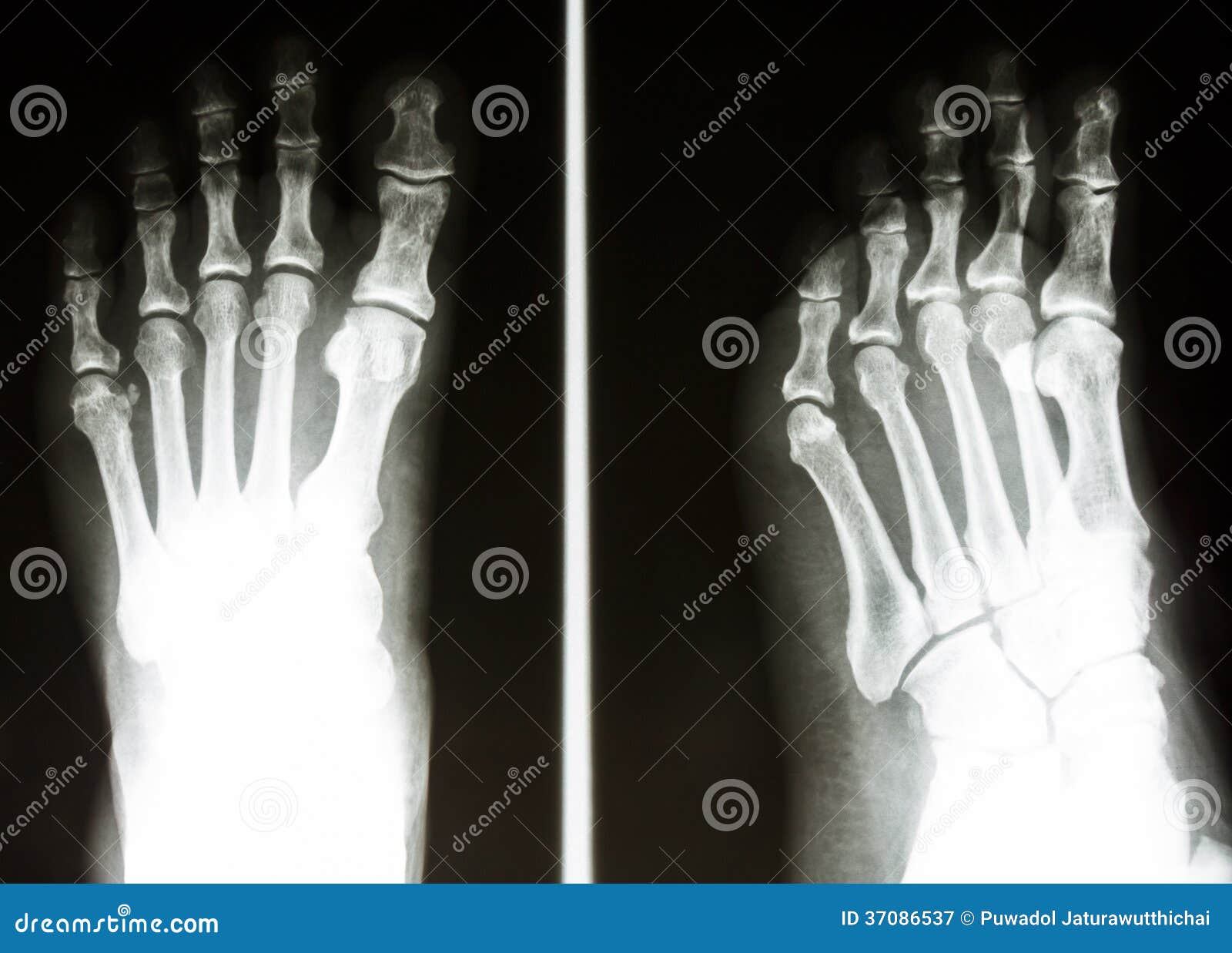 Normaal Been Van De Voet Van De Mens Stock Afbeelding - Image of film ...
