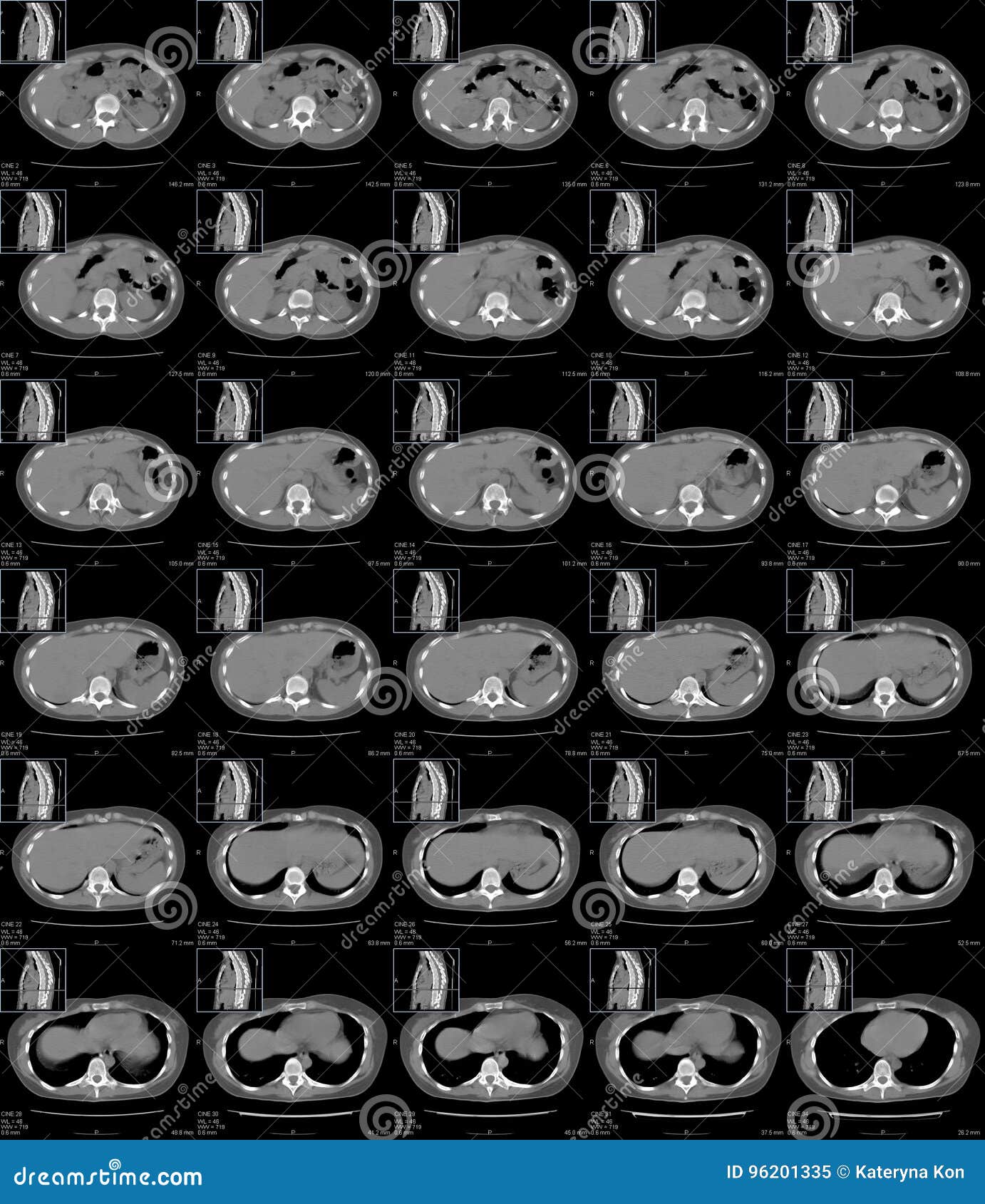 Normal Abdomen and Chest on CT Images Stock Image - Image of black ...