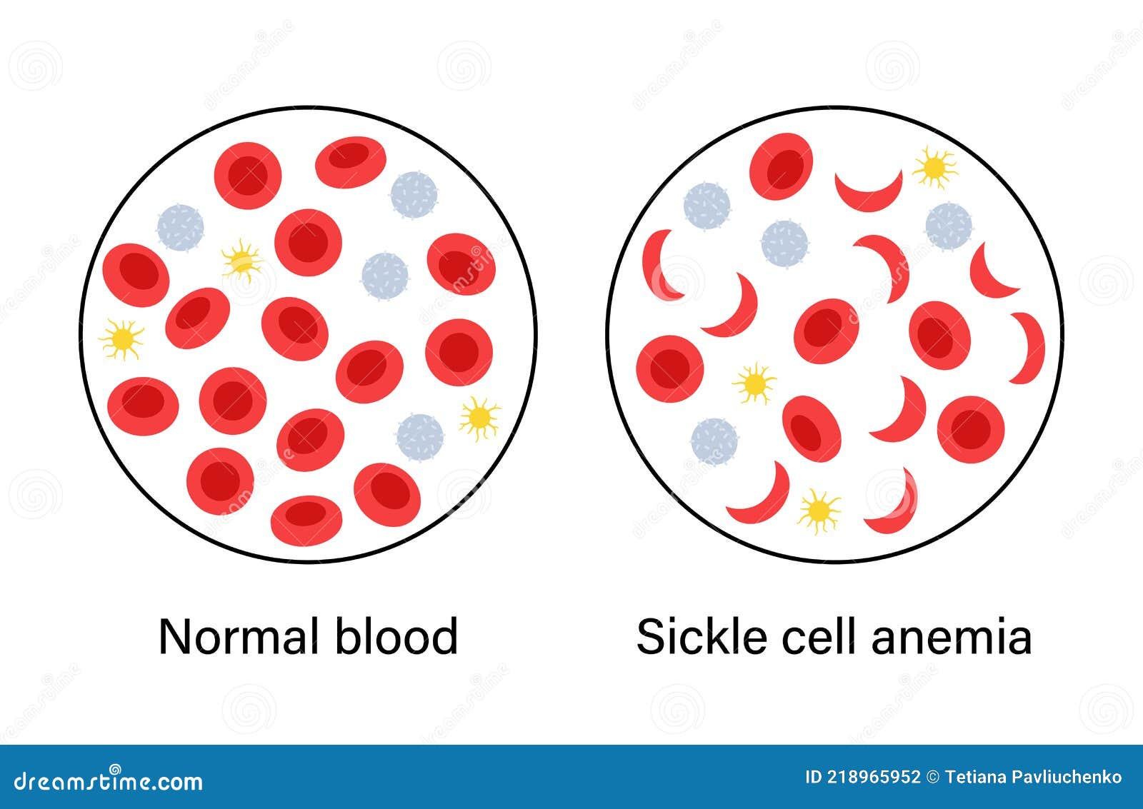 Sickle Cells Royalty-Free Illustration | CartoonDealer.com #149529270
