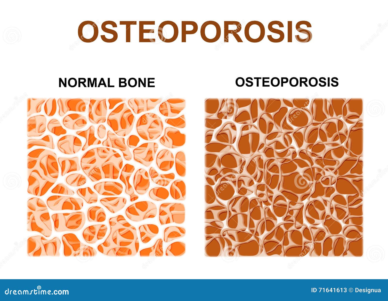 Normal Bone Structure Density And With Osteoporosis Royalty-Free Stock ...