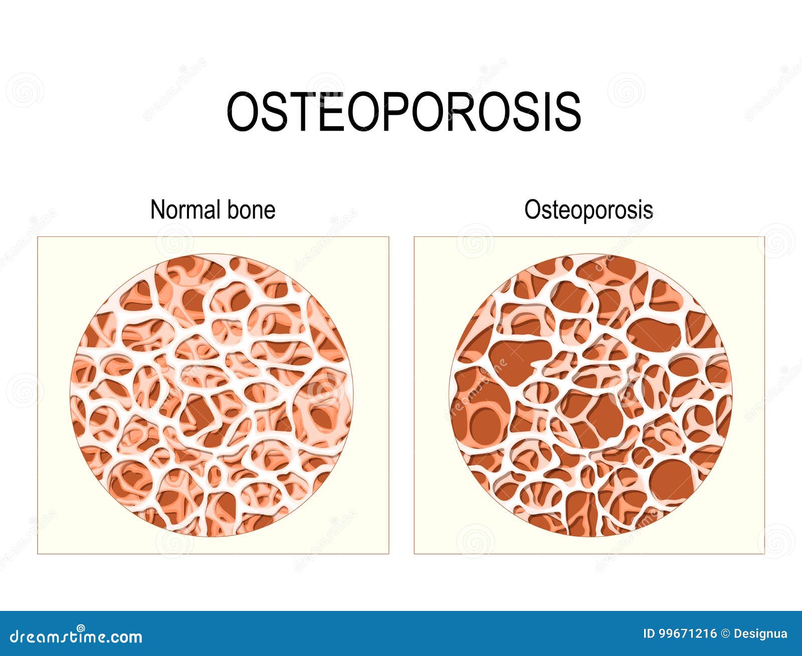 Normal Bone Structure Density And With Osteoporosis Royalty-Free Stock ...