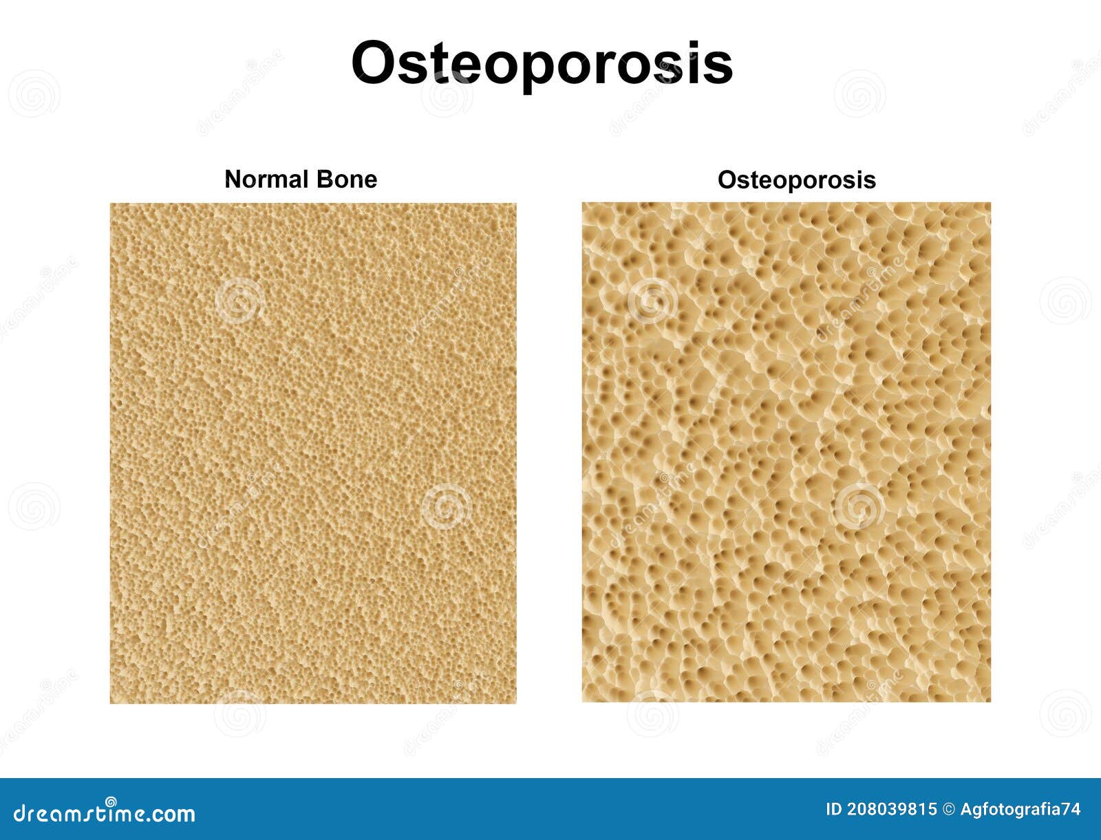 Normal Bone Structure Density and with Osteoporosis Stock Illustration ...