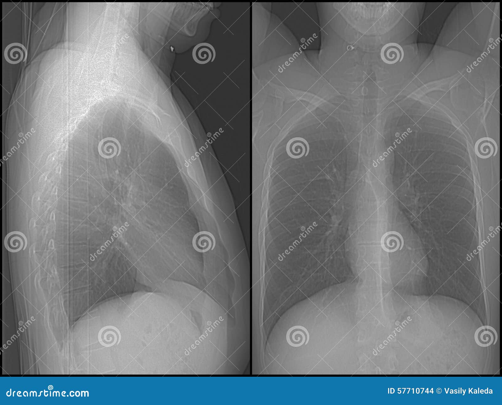 Normal chest on X-ray stock photo. Image of disease, irradiation - 57710744