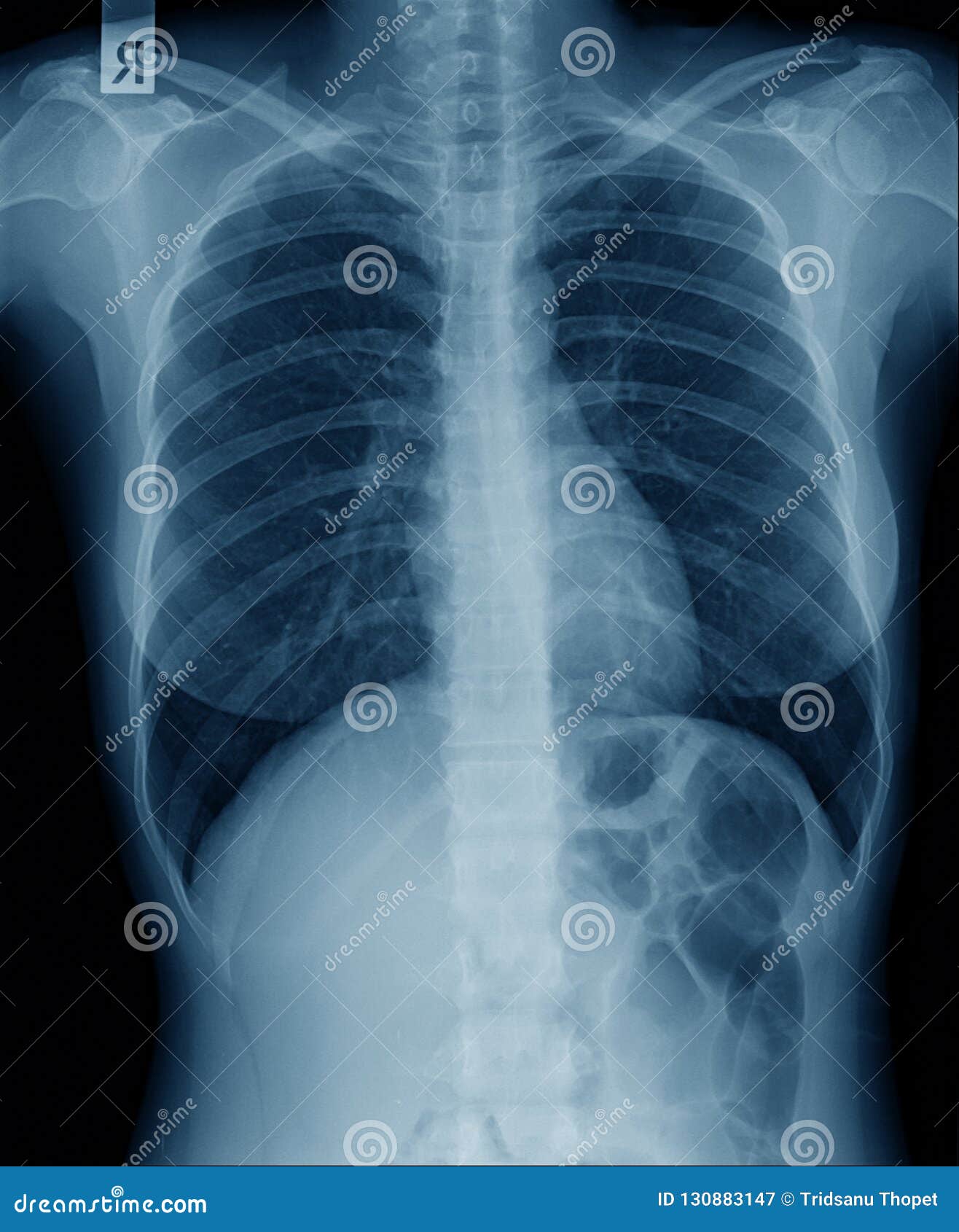 Chest X-ray Image in Blue Tone Stock Image - Image of laboratory ...