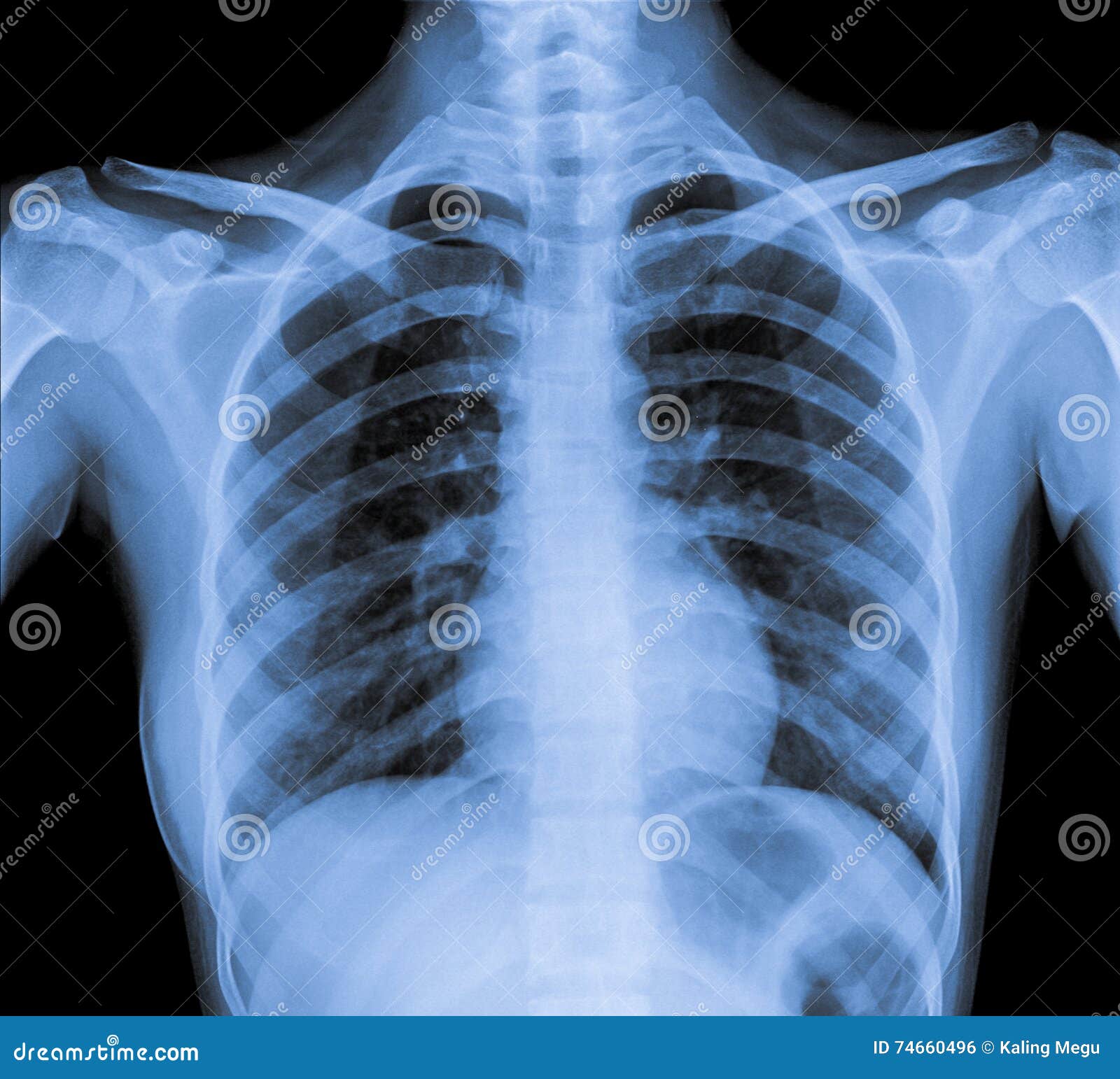 Normal Chest X Ray stock photo. Image of patient, radiation - 74660496