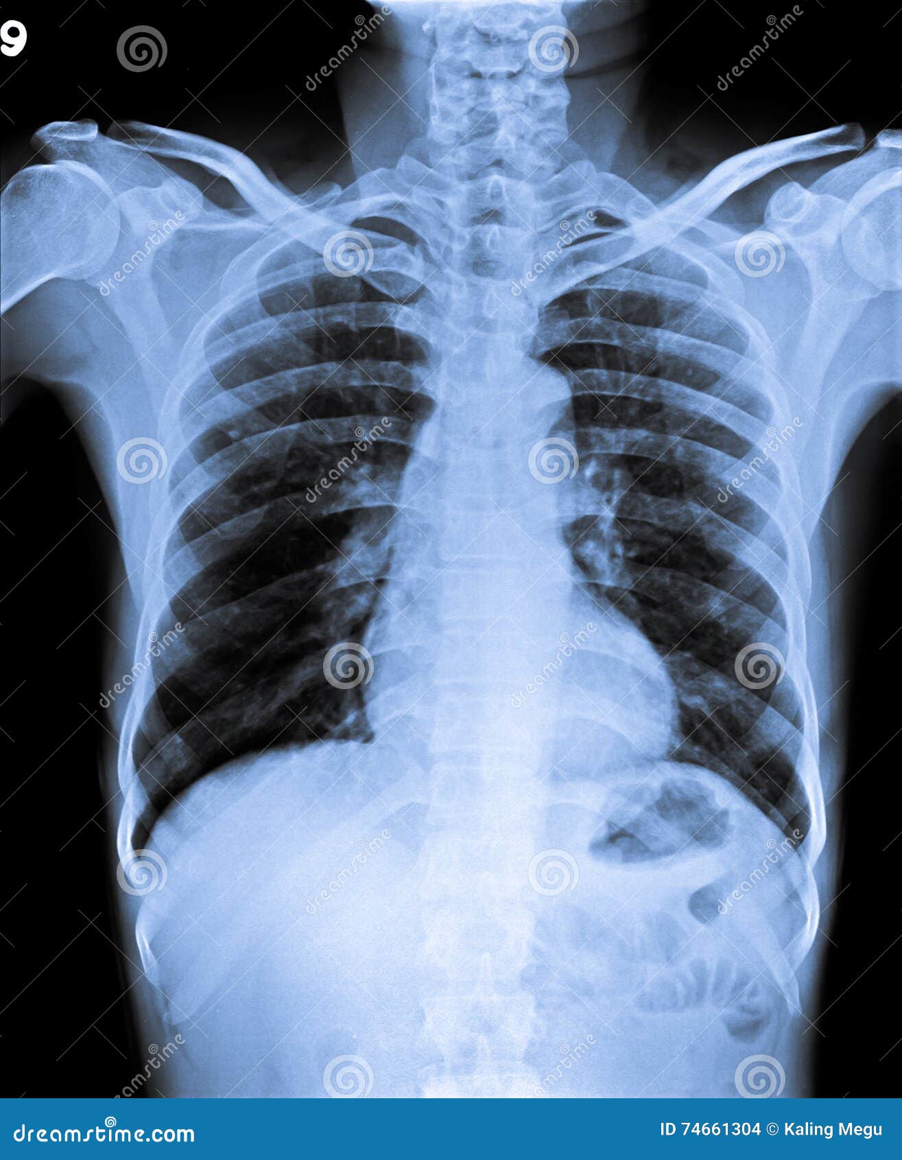 X Ray Chest Anatomy