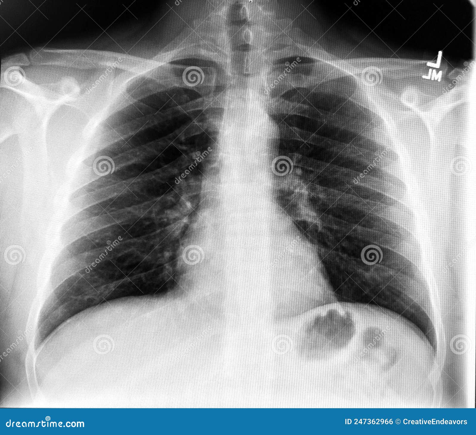 Normal Chest X-Ray - Black And White Radiograph Stock Photo ...