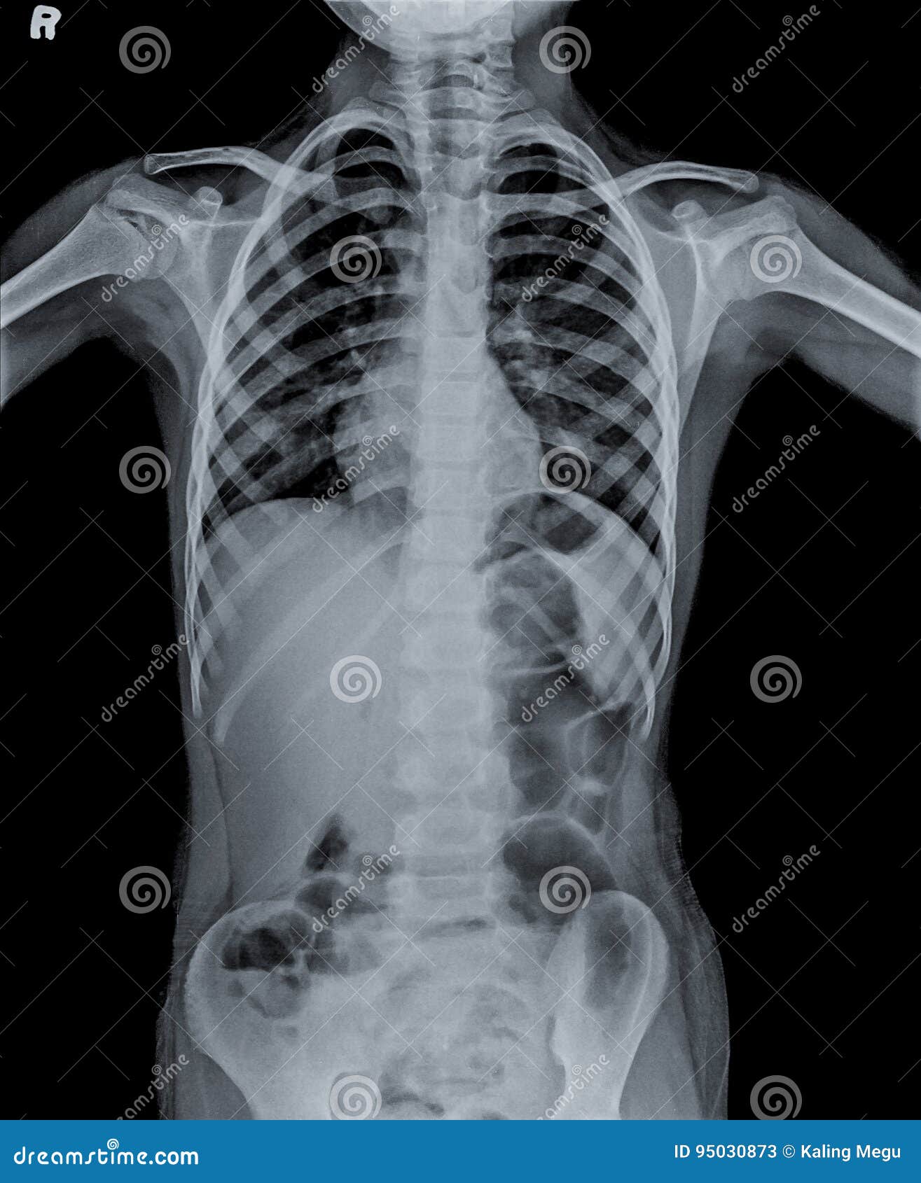 Normal Chest X Ray Of Human Child. Royalty-Free Stock Photography ...