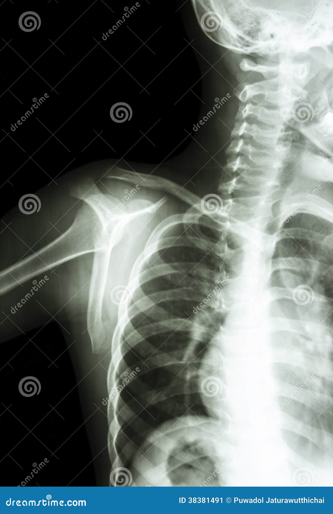 Normal childs shoulder stock image. Image of lung, care - 38381491