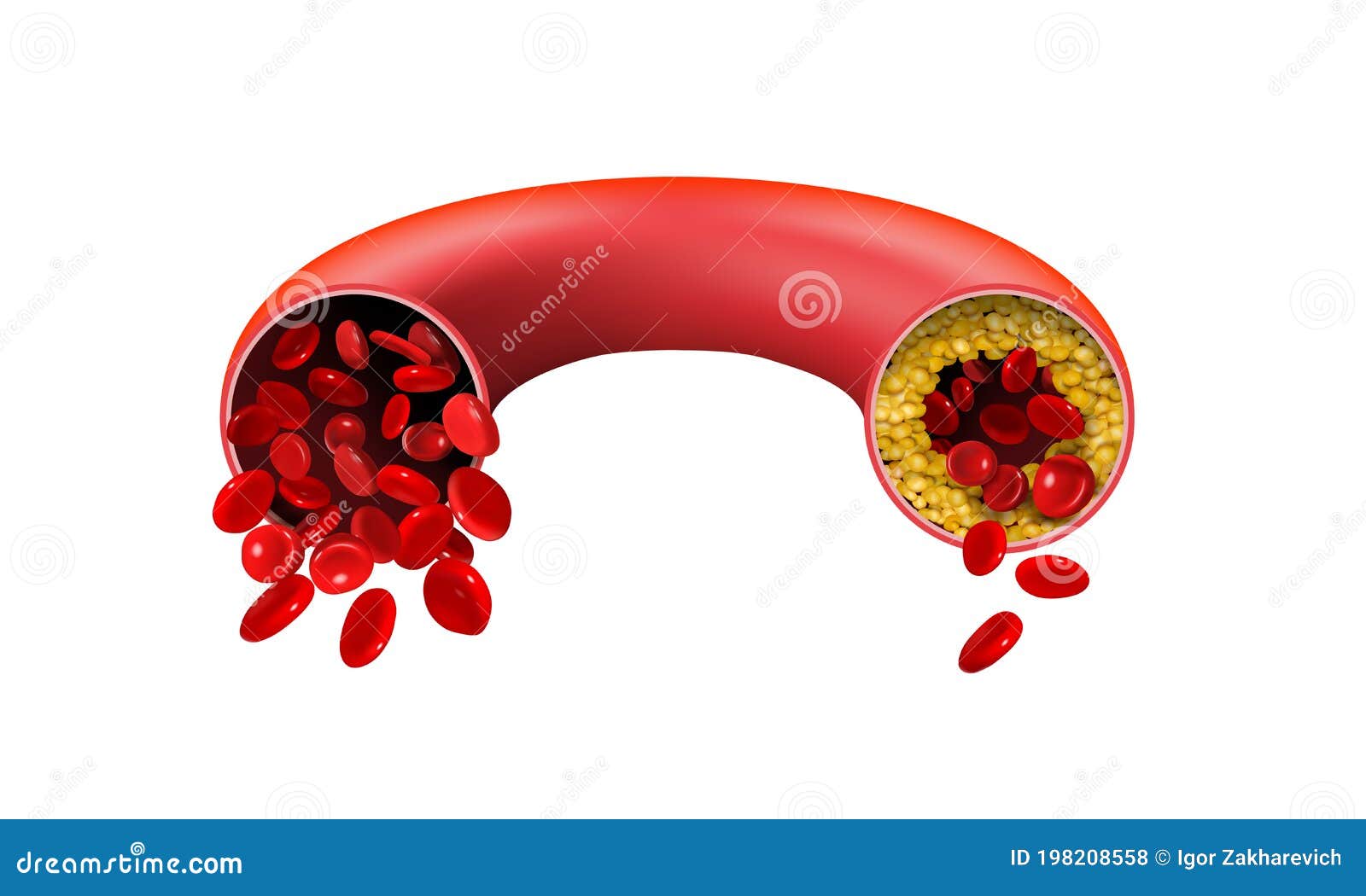Normal and Cholesterol-blocked Artery on a White Background. Stock ...