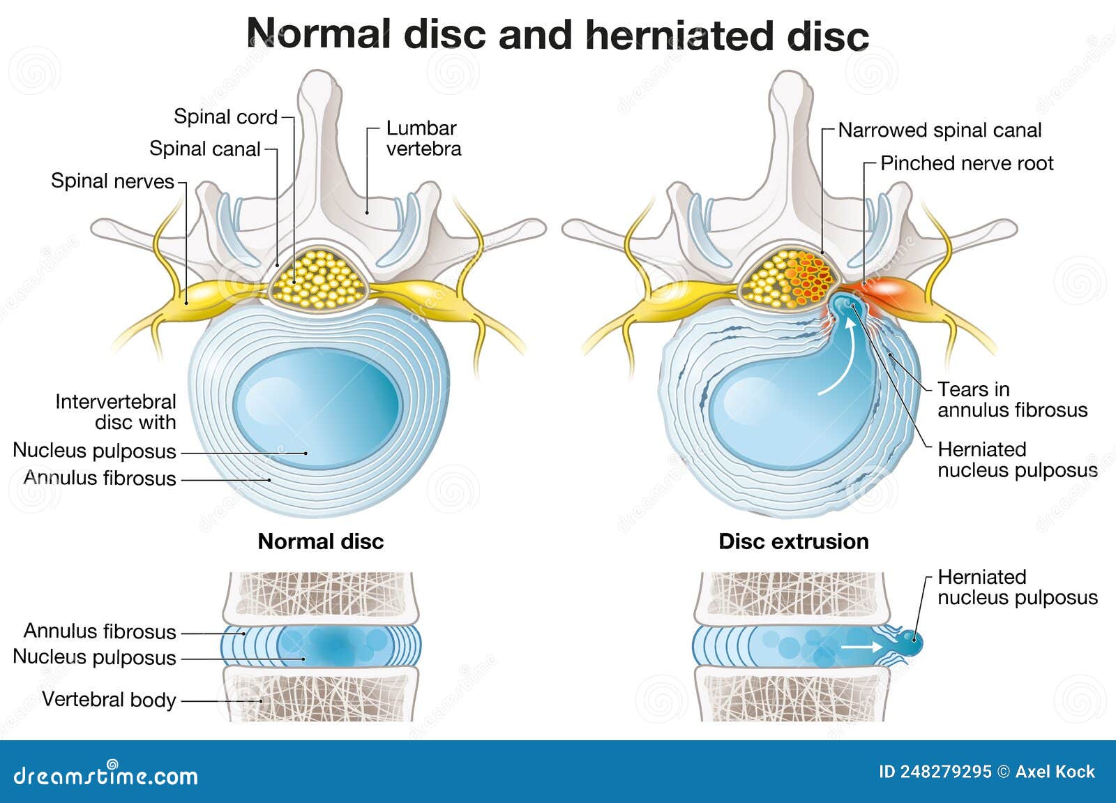 Normal Disc And Spinal Disc Herniation In Cervical Vertebrae Cartoon ...