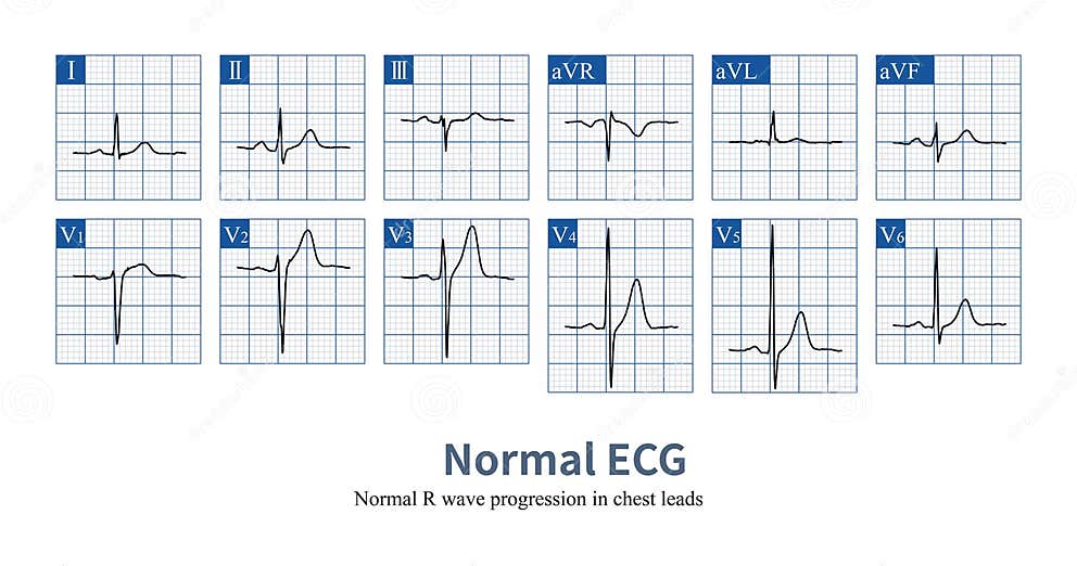 Normal ECG stock illustration. Illustration of repolarization - 348425630