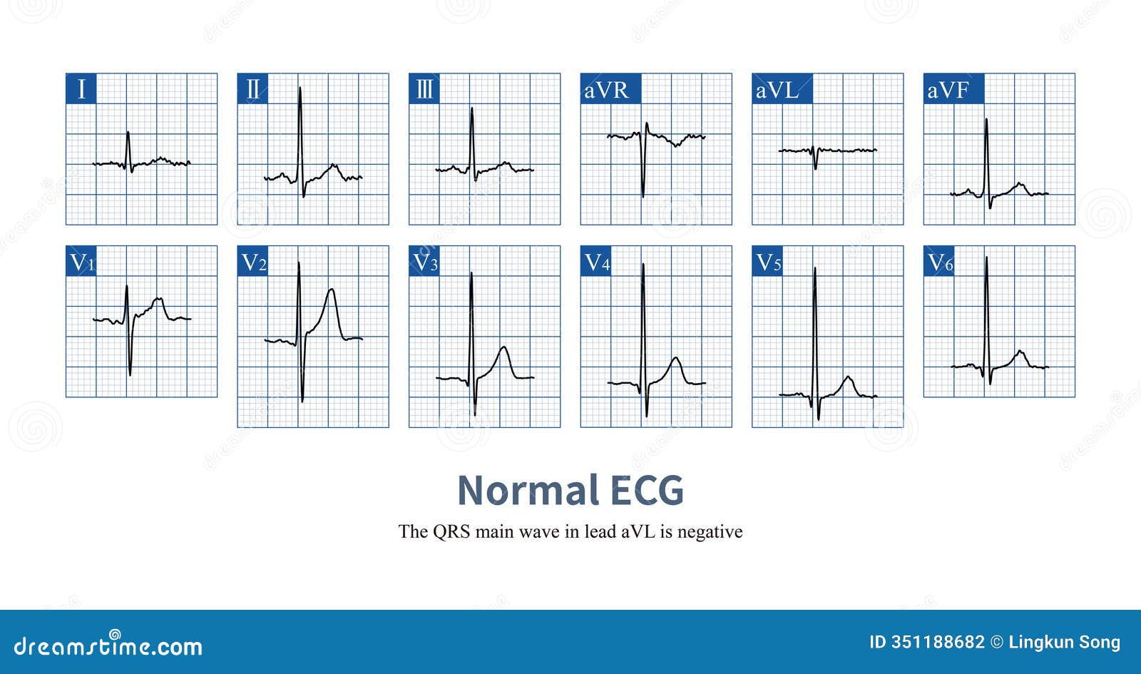 Normal ECG stock photo. Image of right, graphic, left - 351188682