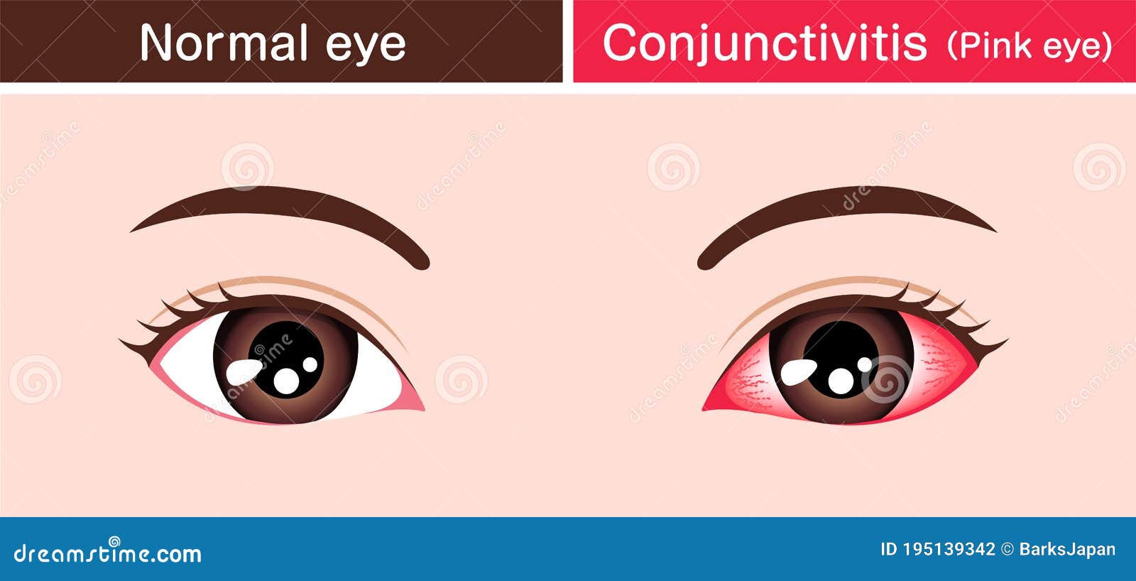 Normal Eye And Conjunctivitis Pink Eye Vector Illustration ... Normal Eye And Conjunctivitis Pink Eye Vector Illustration ...