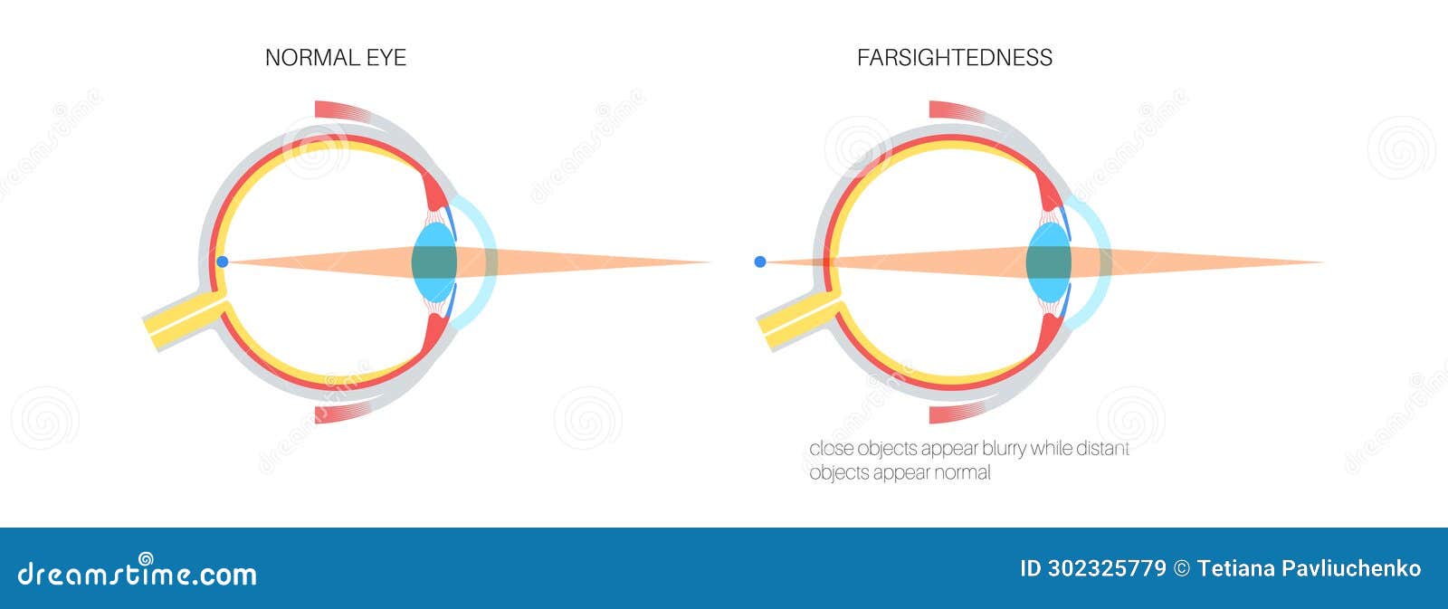 Hyperopia Hypermetropia - Farsightedness Eye Flashcard Illustration ...