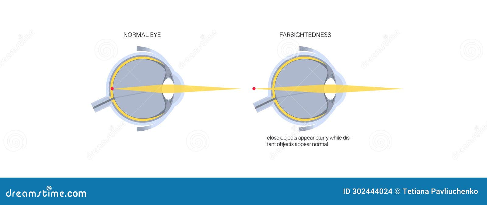 Normal Eye and Farsightedness Stock Vector - Illustration of body ...