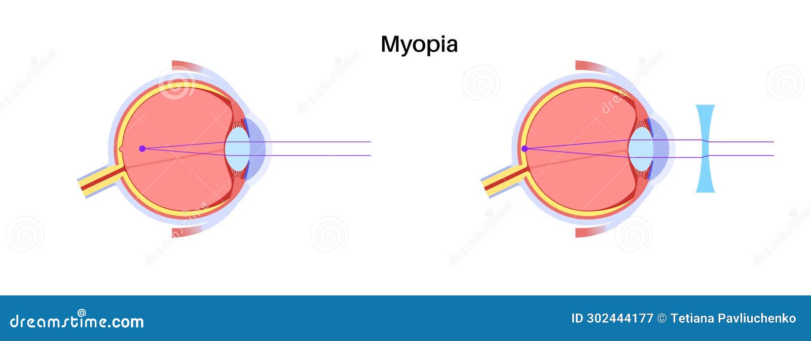 Normal Eye and Nearsightedness Stock Vector - Illustration of human ...
