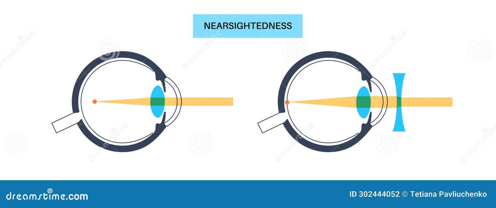 Normal Eye and Nearsightedness Stock Vector - Illustration of organ ...