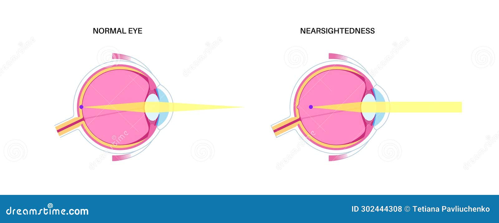 Nearsightedness Eye Disease Vector Illustration | CartoonDealer.com ...