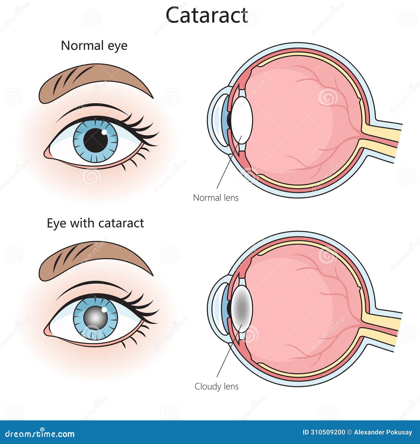 Cataract Structure Diagram Medical Science Stock Illustration ...