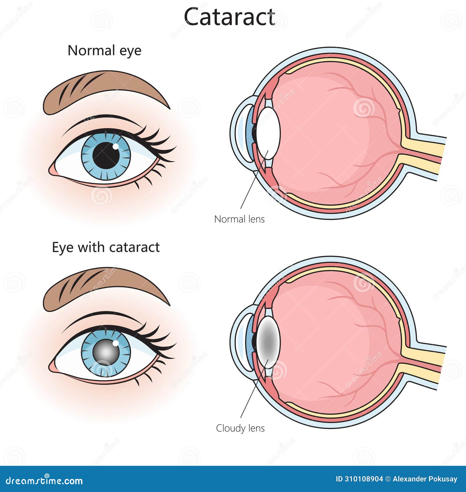 Cataract Structure Diagram Medical Science Stock Vector - Illustration ...