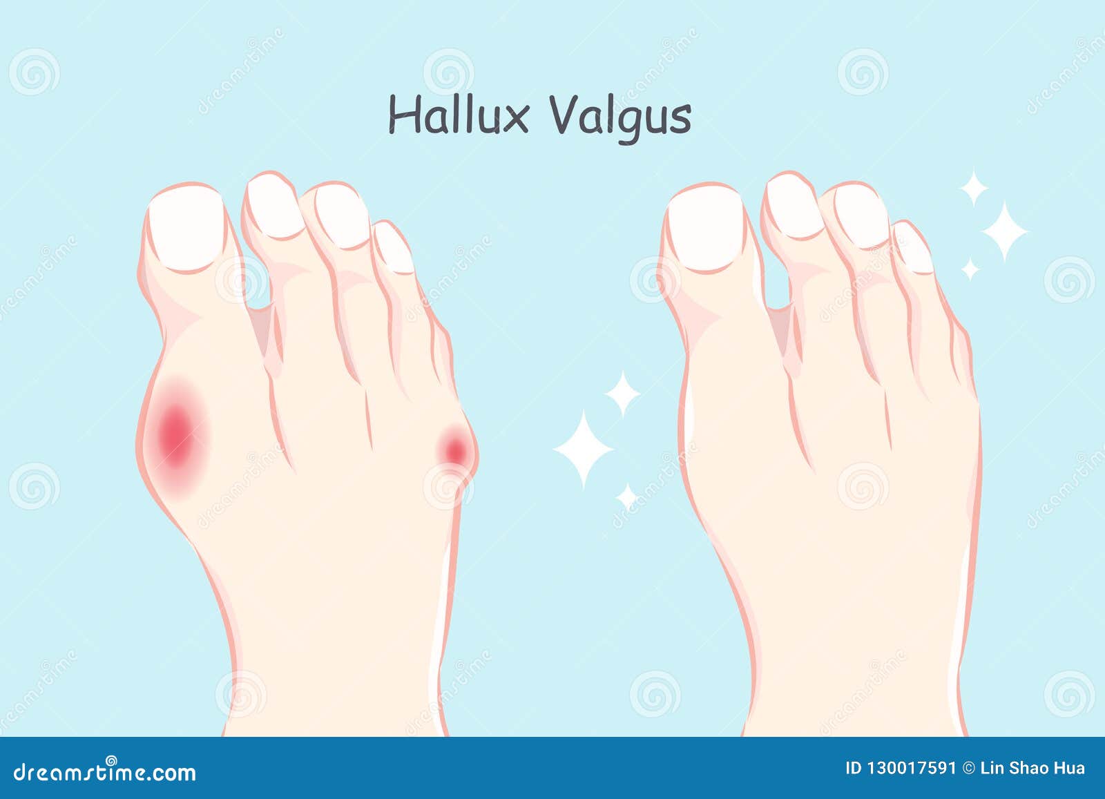 Normal Foot and Hallux Valgus Stock Vector - Illustration of condition ...