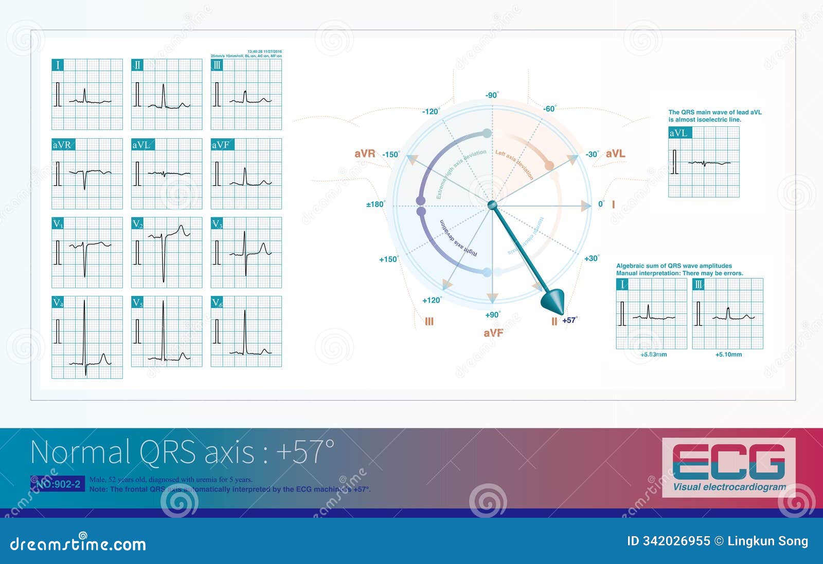 Normal frontal QRS axis stock illustration. Illustration of lead ...