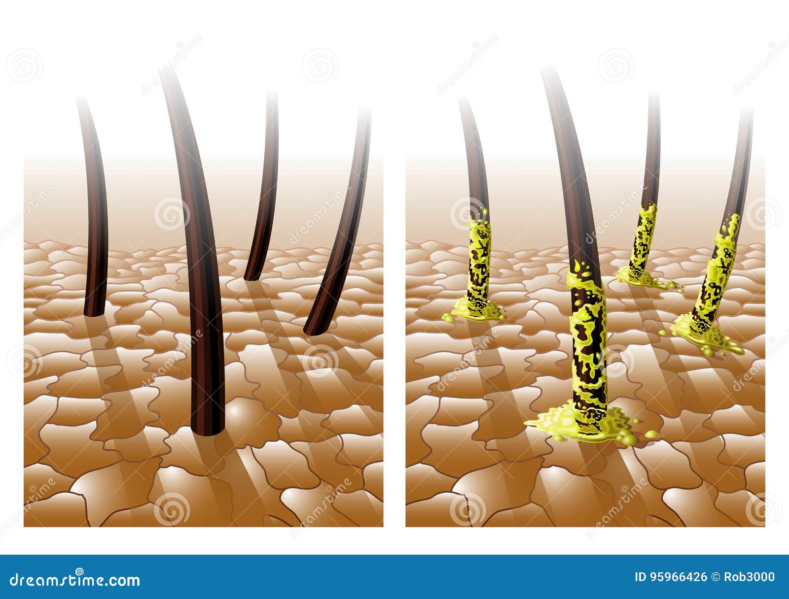 Normal And Greasy Hair Vector Illustration | CartoonDealer.com #95966426