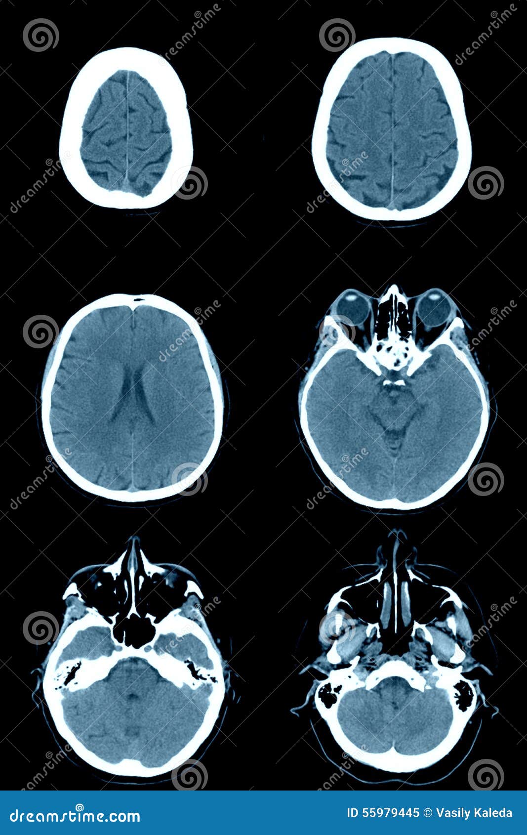 Normal head on CT scans stock image. Image of tissue - 55979445