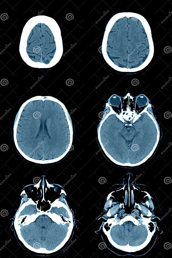 Normal head on CT scans stock image. Image of tissue - 55979445