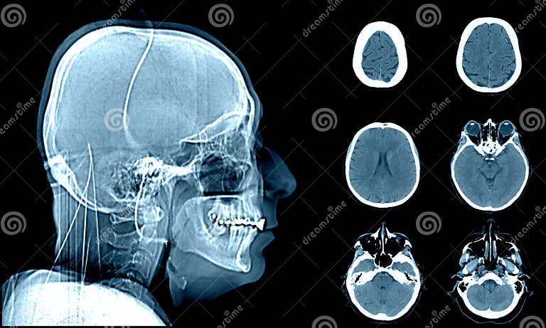 Normal head on CT scans stock photo. Image of human, matter - 55979524