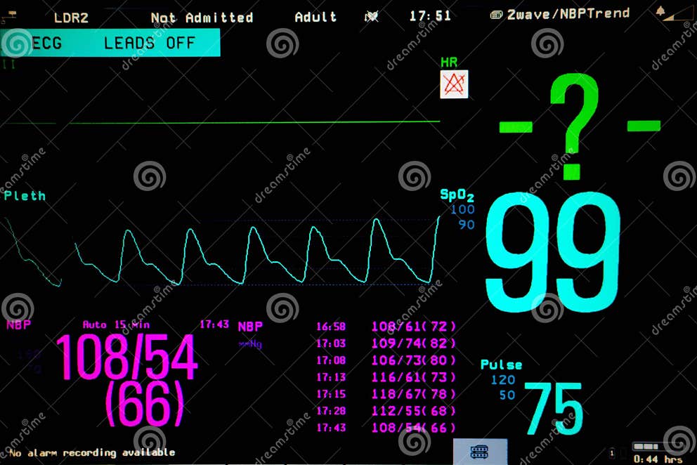 Normal Heart Function on Pulse Oximeter Pleth Graph Bar Stock Photo ...