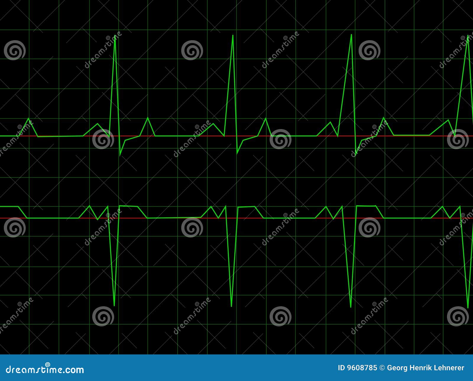 Normal Heart Rhythm( Normal Sinus Rhythm). Royalty-Free Cartoon ...