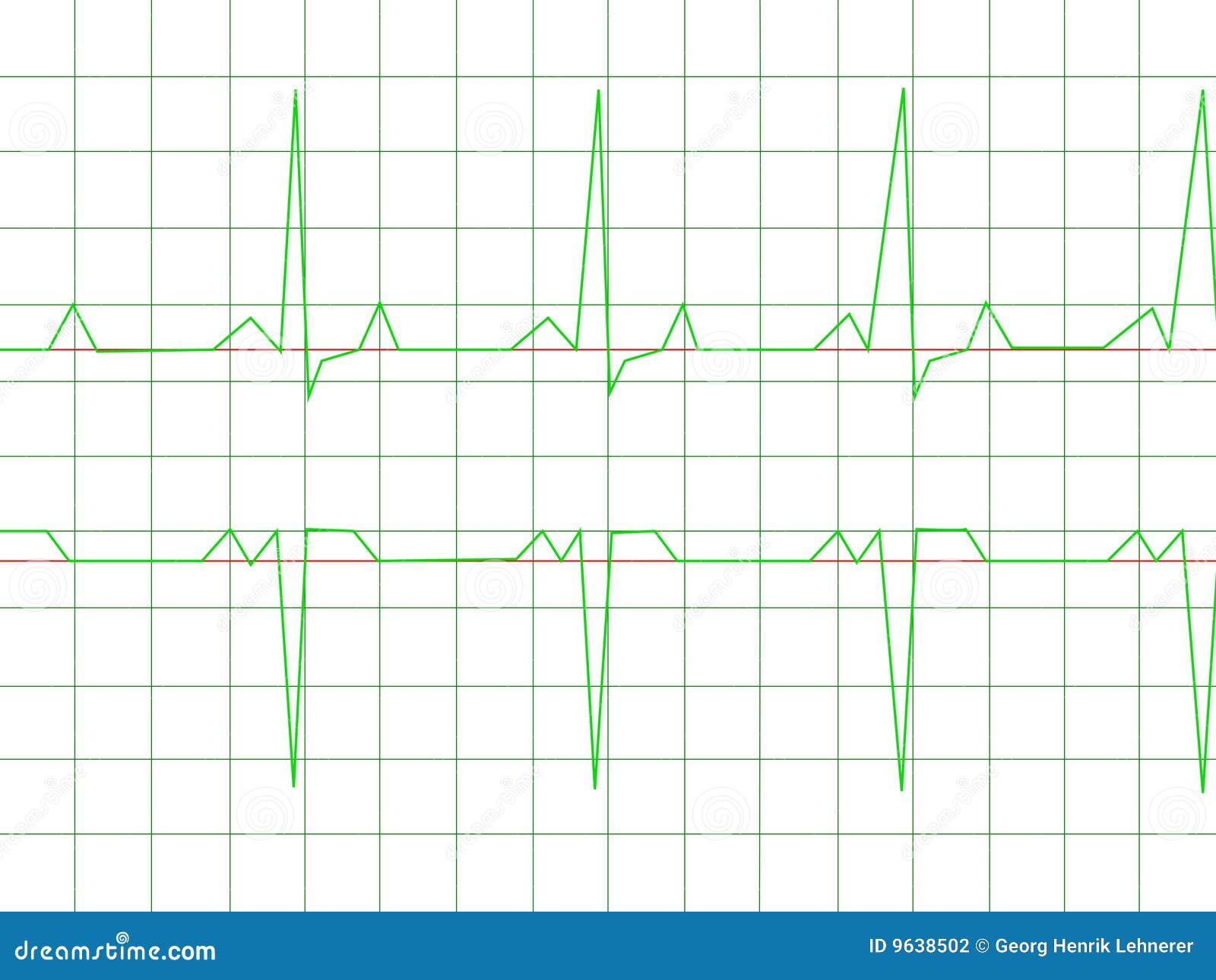 Normal Heart Function And Normal Heart Rhythm