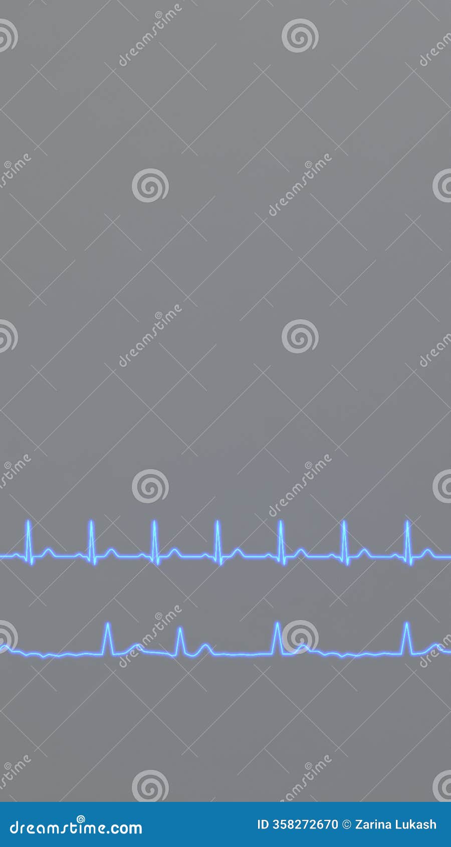 Normal Heart Rhythm ECG and Atrial Fibrillation Stock Photo - Image of ...