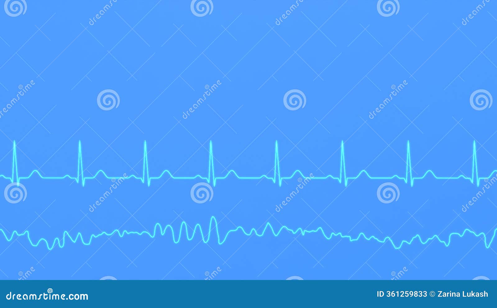 Normal Heart Rhythm ECG And Ventricular Fibrillation Stock Image ...