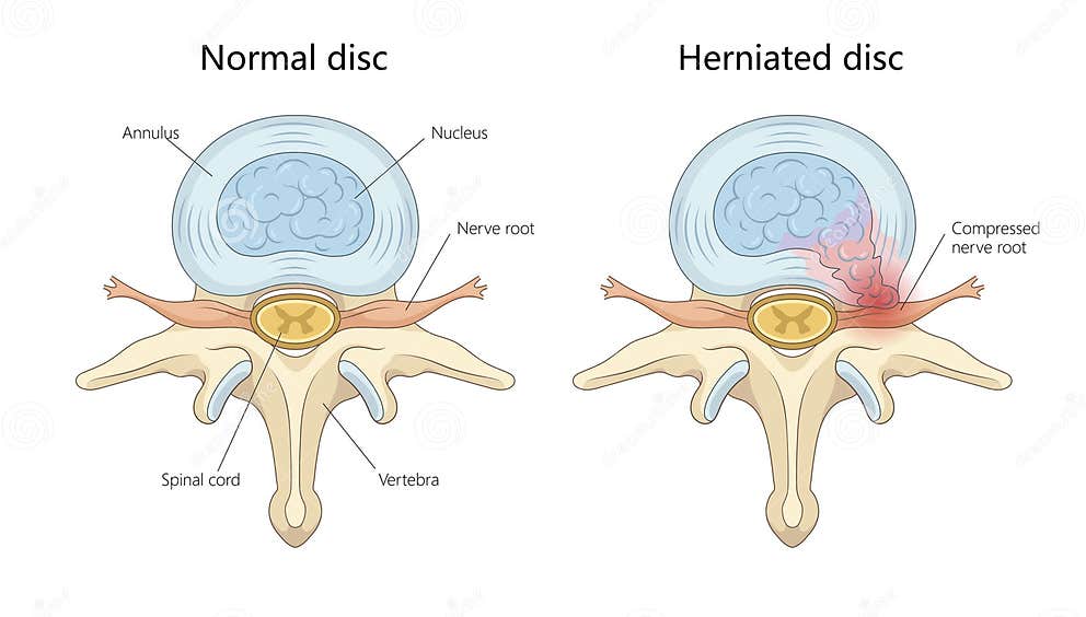 Normal and Herniated Spinal Discs Diagram Medical Stock Vector ...