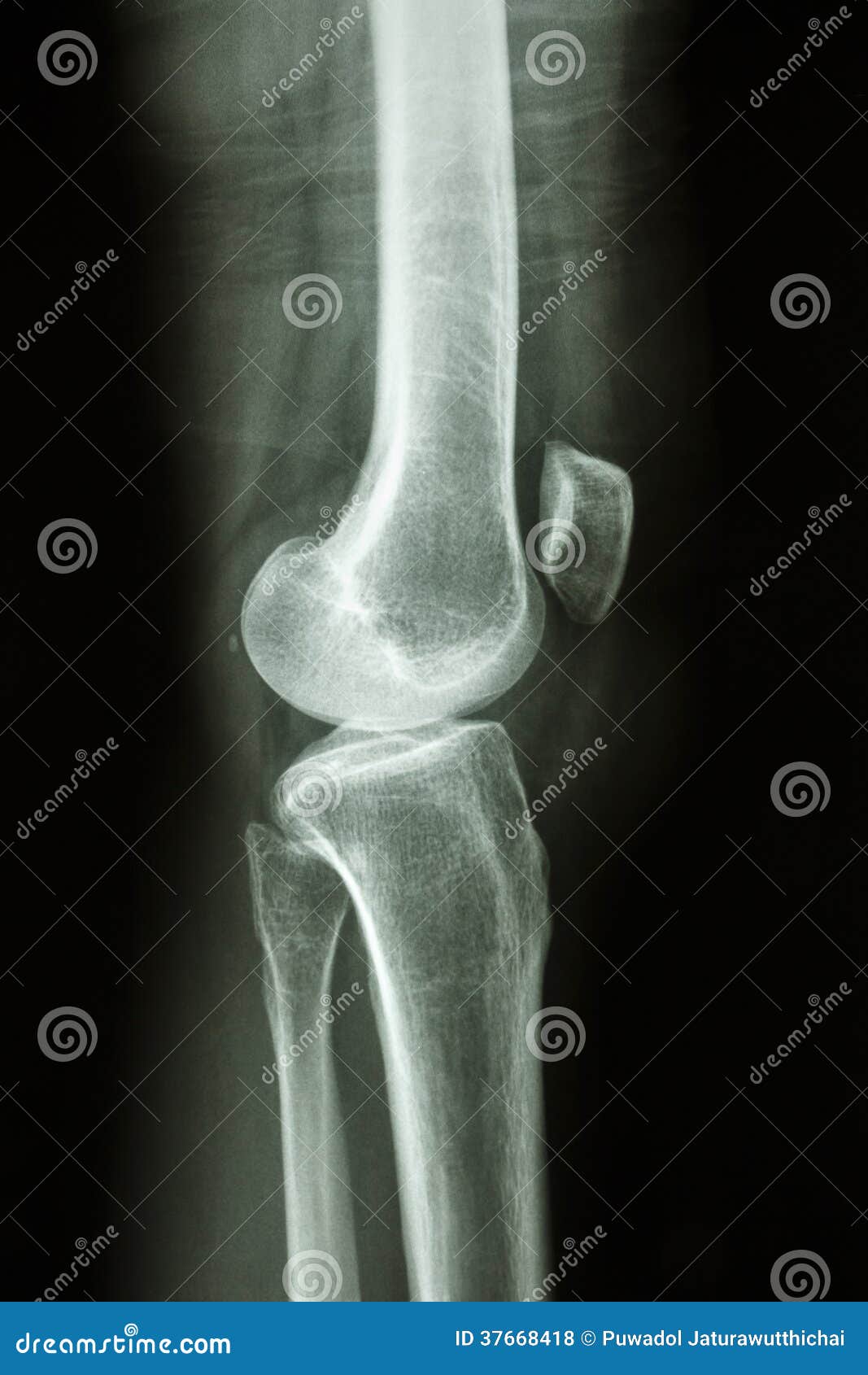 Normal human s knee joint stock photo. Image of background - 37668418
