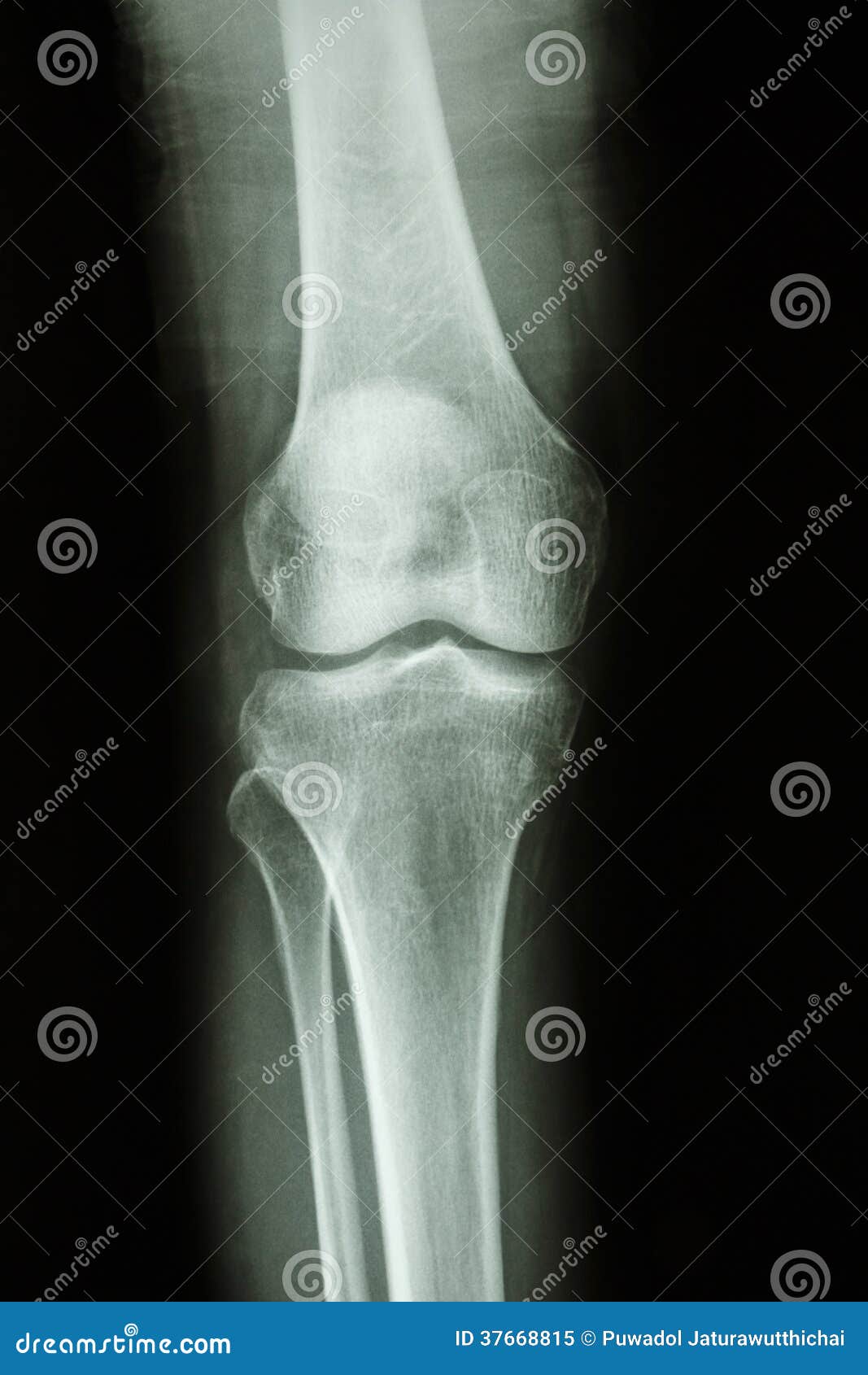 X-ray Knee Ap Normal Radiography Of The Knee Joint, Medical Diagnostics ...