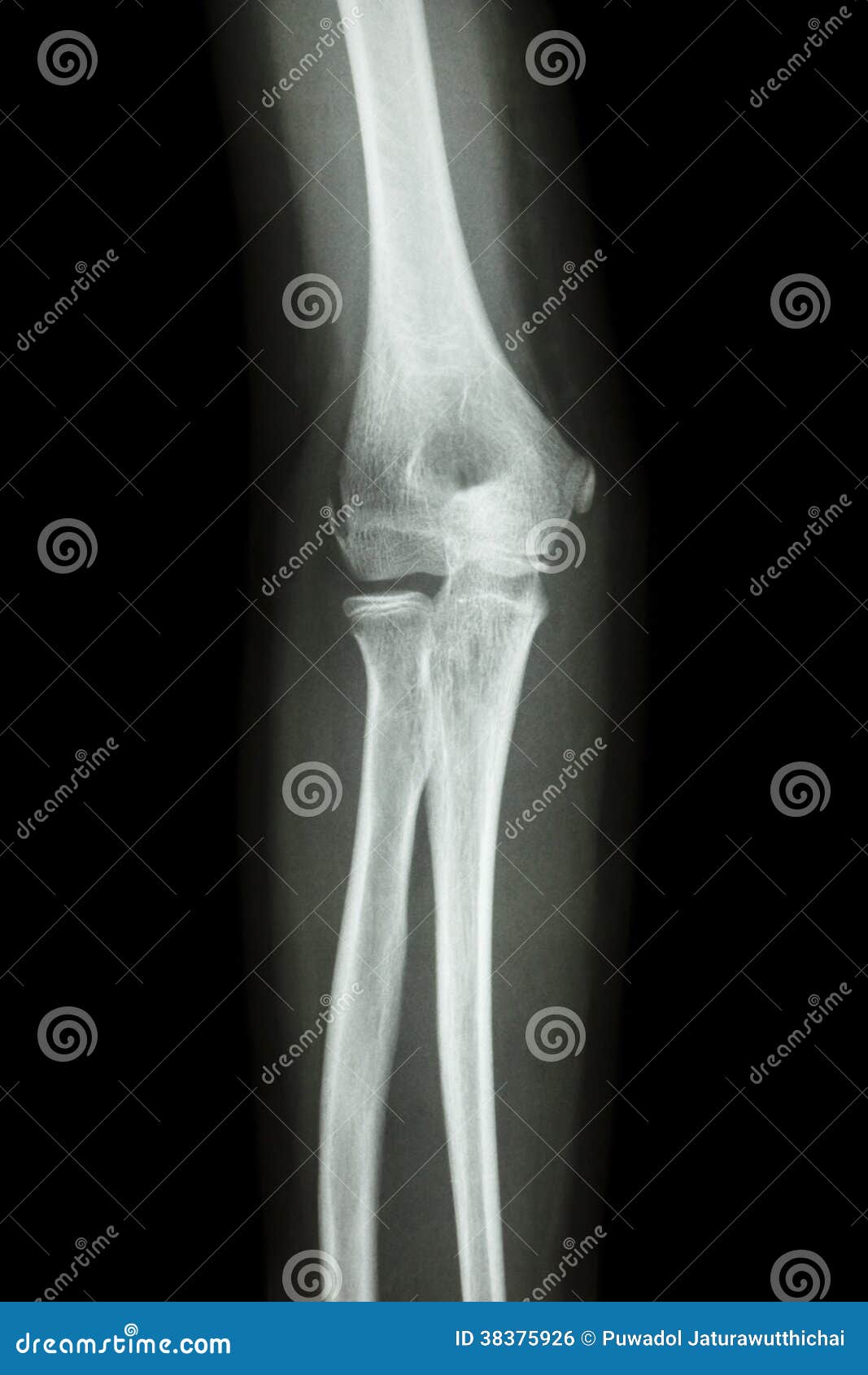 Normal humans elbow stock photo. Image of patient, forearm - 38375926