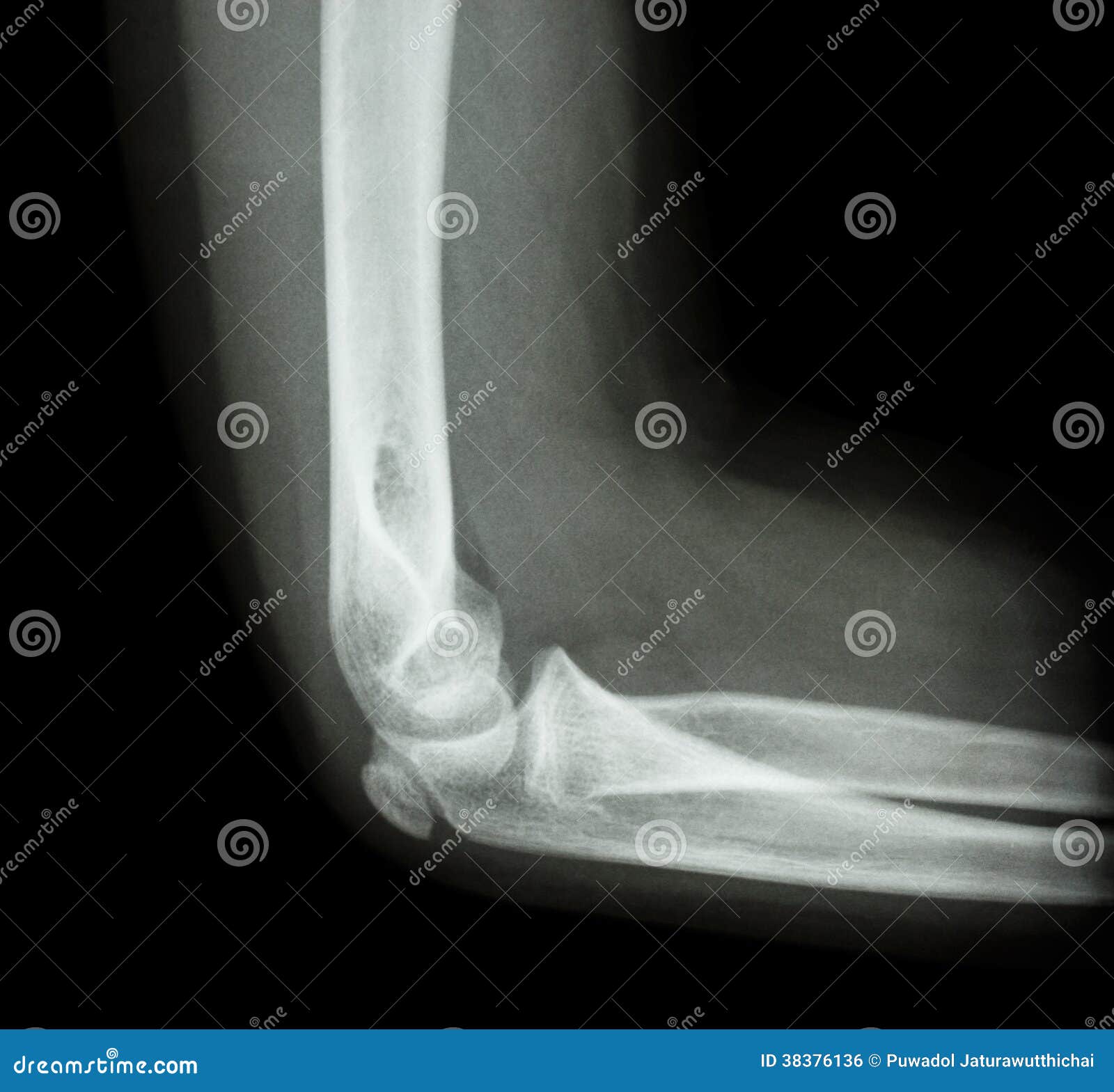 Normal Humans Elbow Royalty-Free Stock Image | CartoonDealer.com #38376136