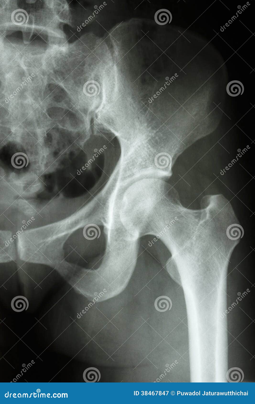 Normal humans hip stock image. Image of patient, people - 38467847