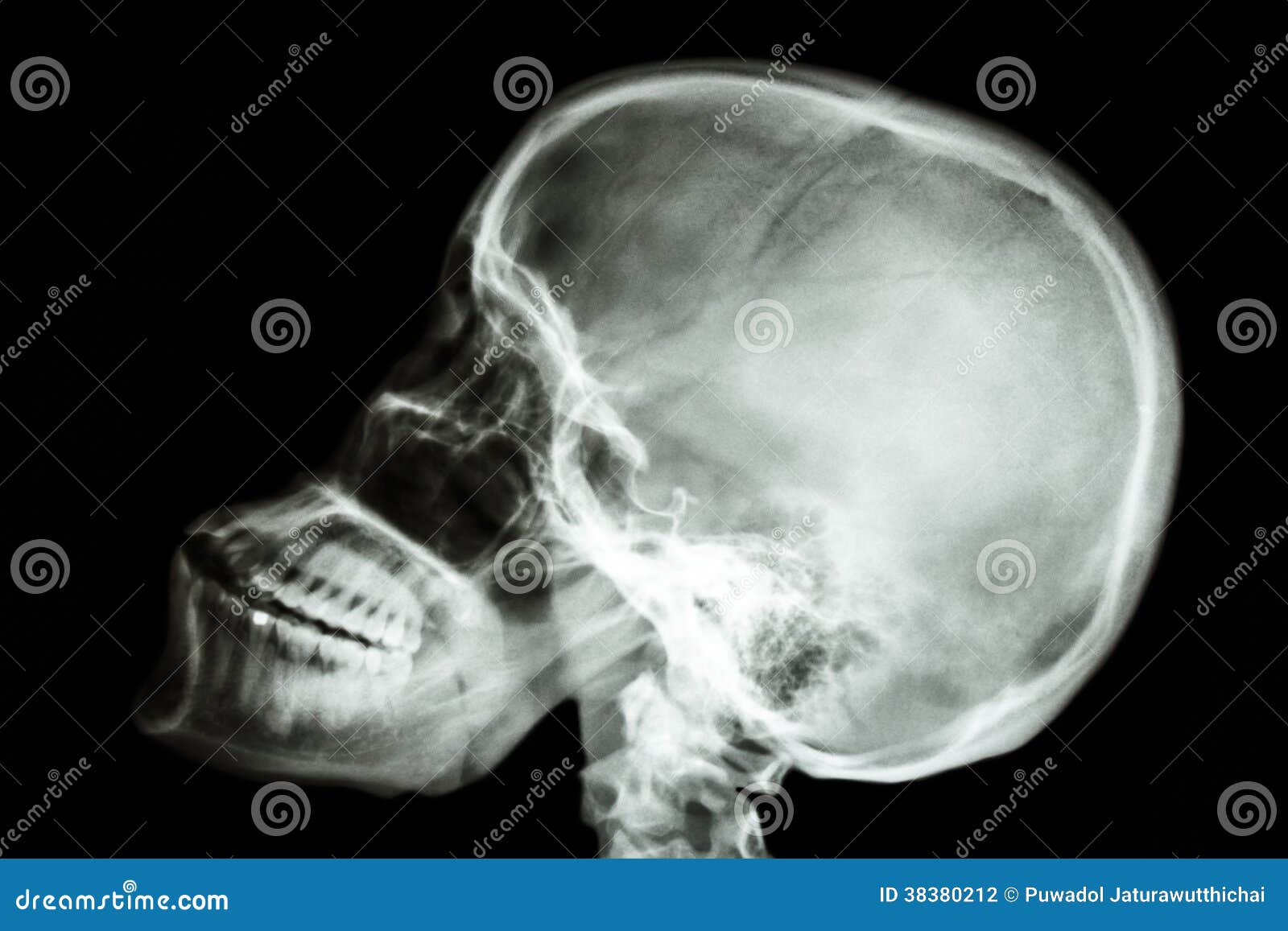 Normal Humans Skull and Cervical Spine Stock Photo - Image of head ...