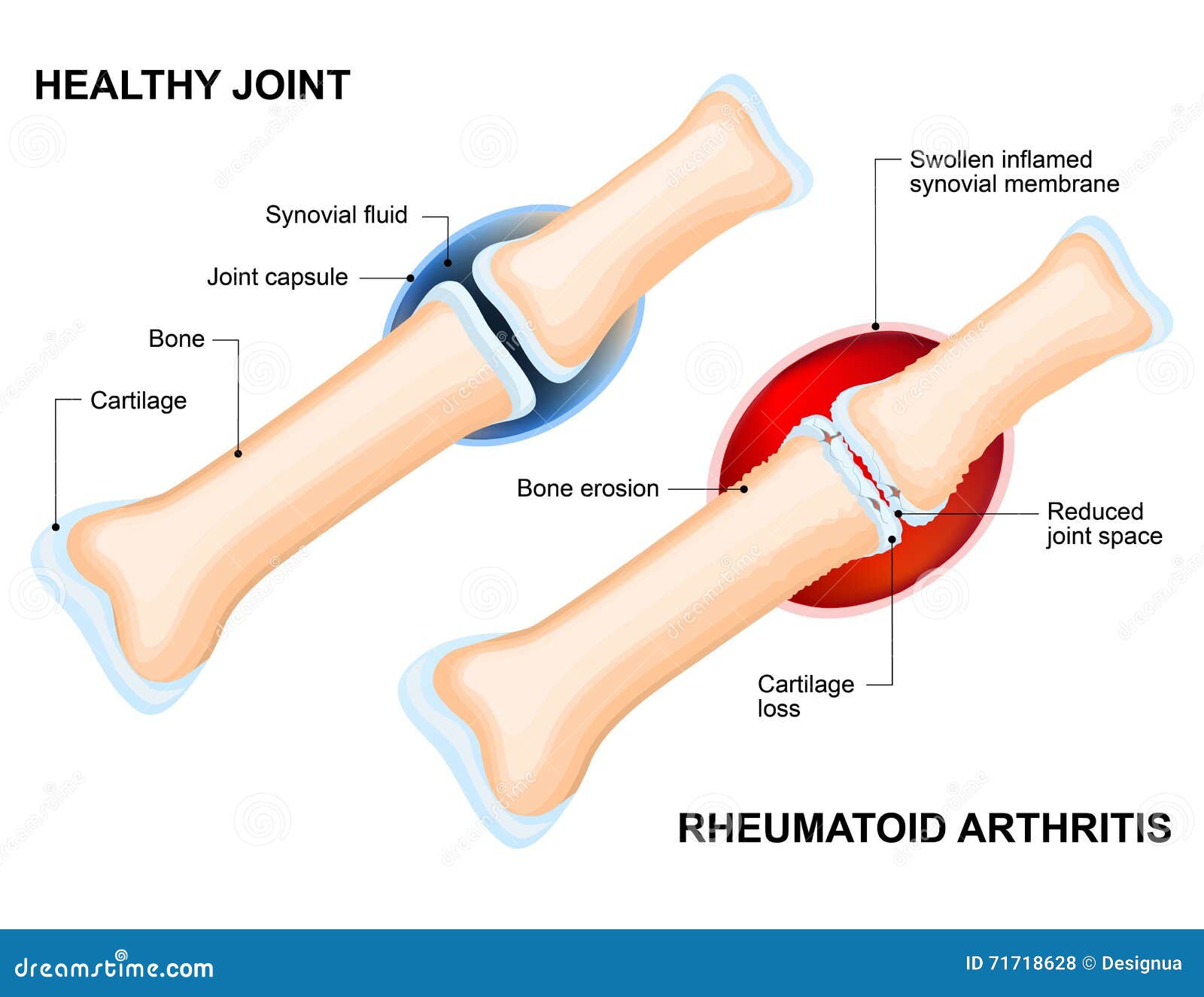 Normal Joint and Rheumatoid Arthritis Stock Vector - Illustration of ...