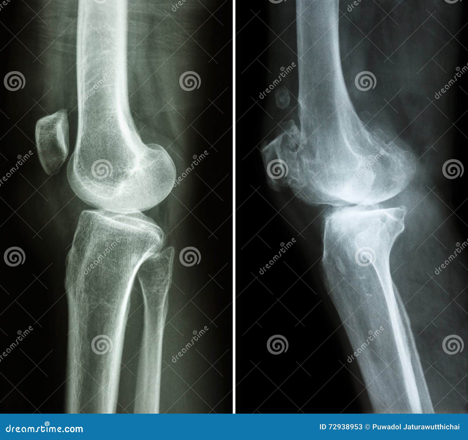 The Right Lateral Position Of Tibial Plateau X-ray Pictures Stock ...
