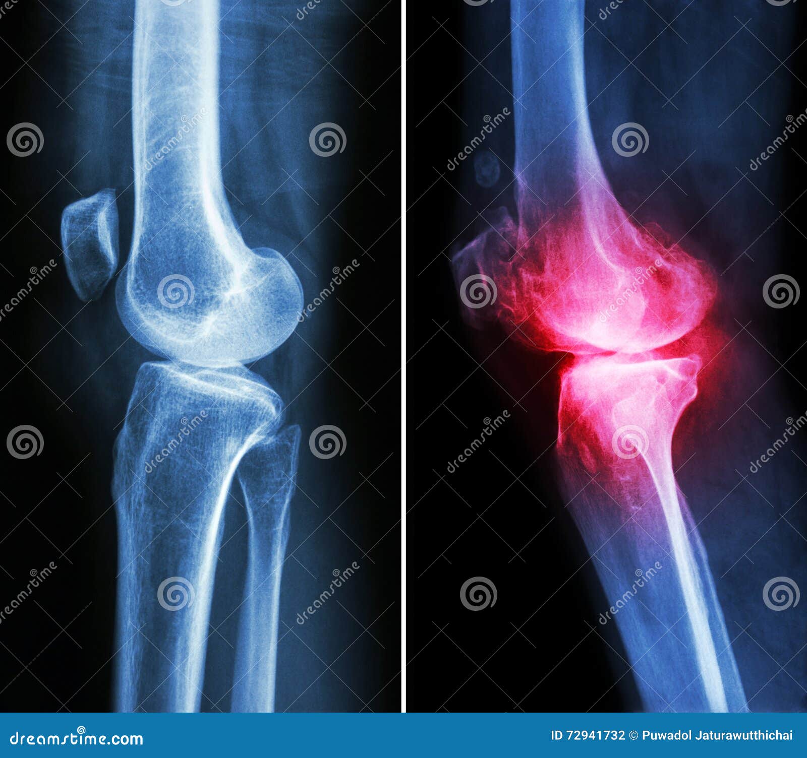 Normal Knee and Osteoarthritis Knee Stock Photo - Image of inflammation ...