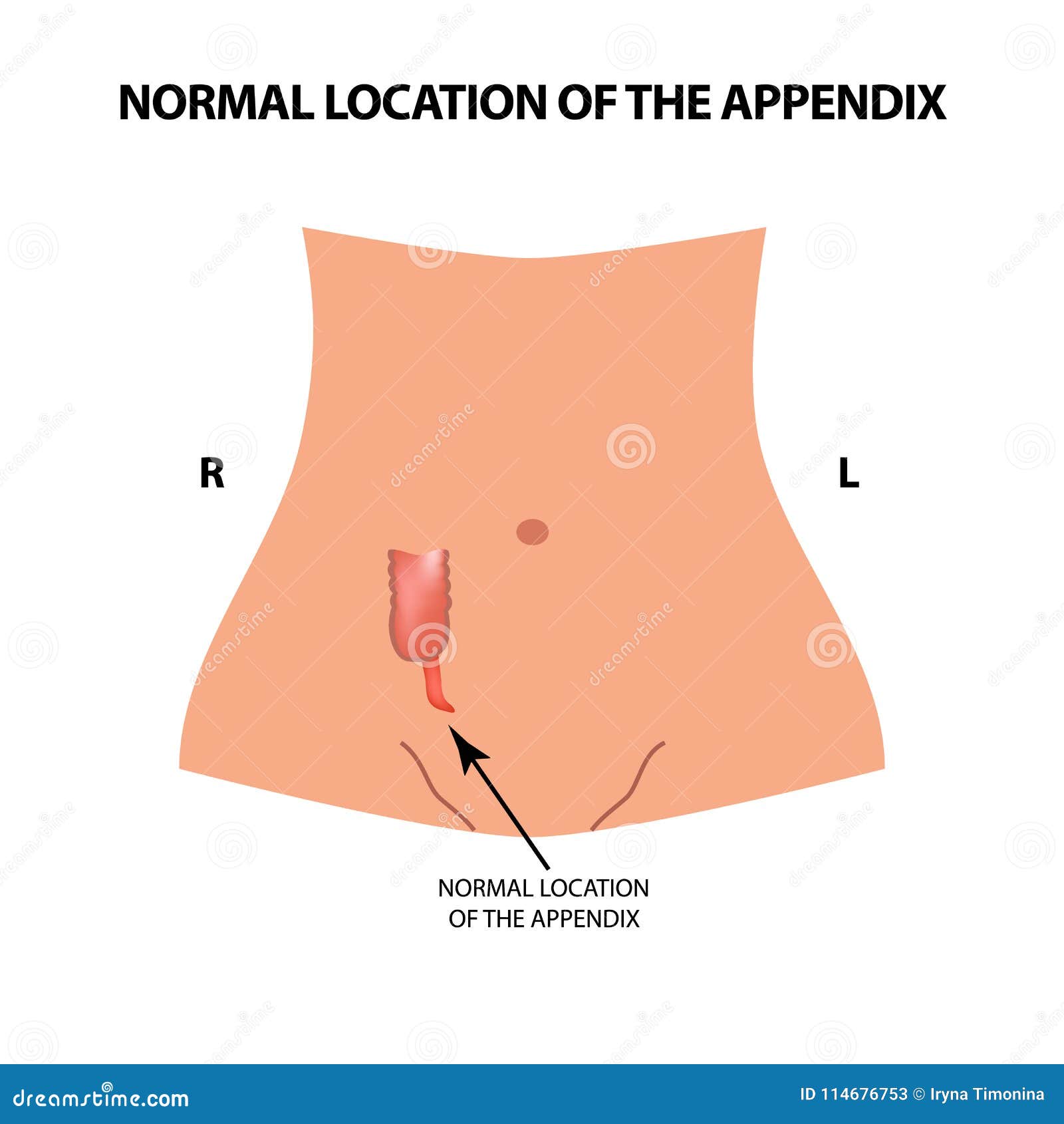 The Normal Location Of The Appendix. Vector Illustration On Isolated Background. Stock Vector ...
