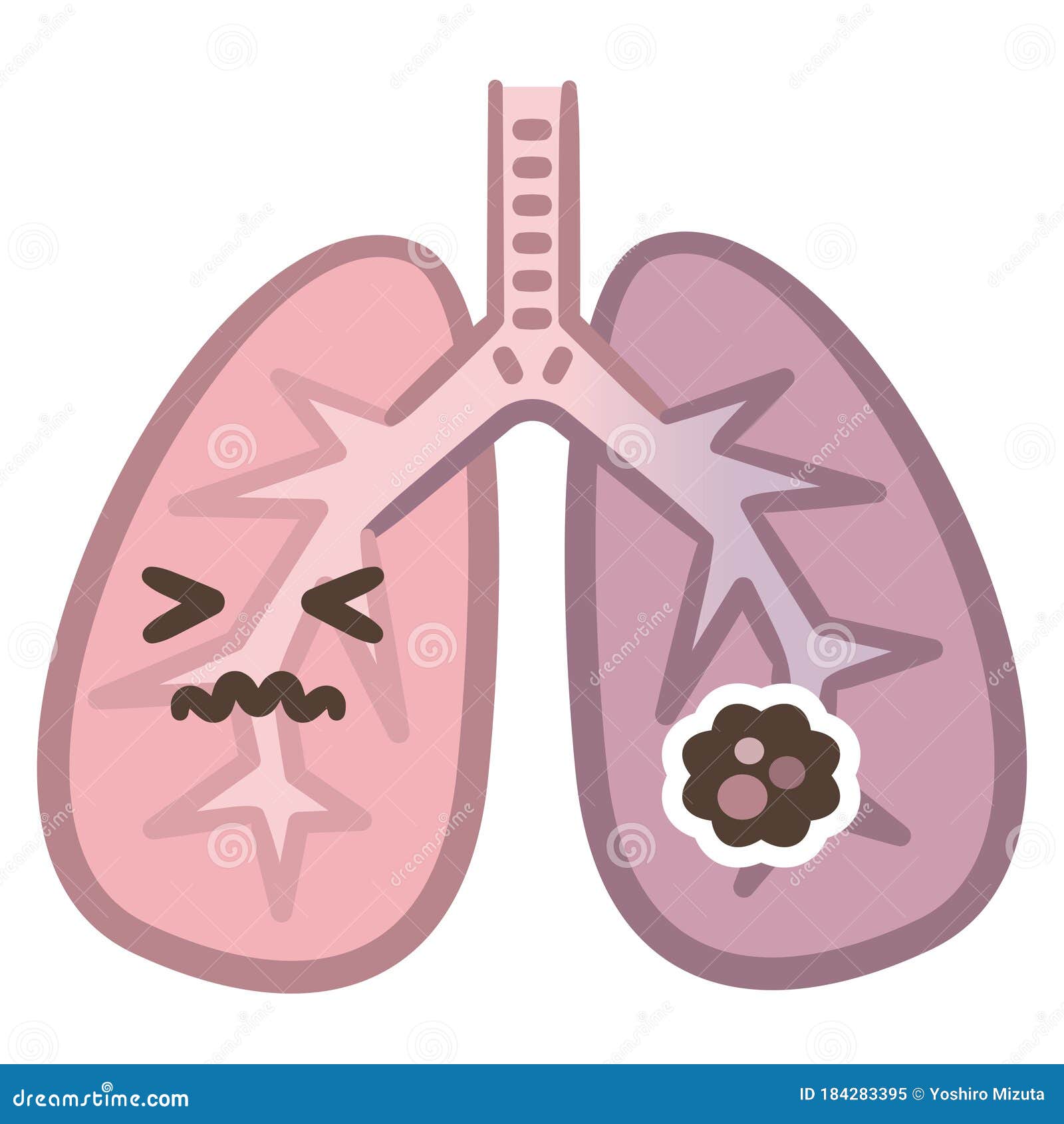 Normal Lung And Lung Cancer Illustration Stock Vector Illustration Of